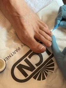 Medical Toenail Reconstruction | Foot & Gait Clinic